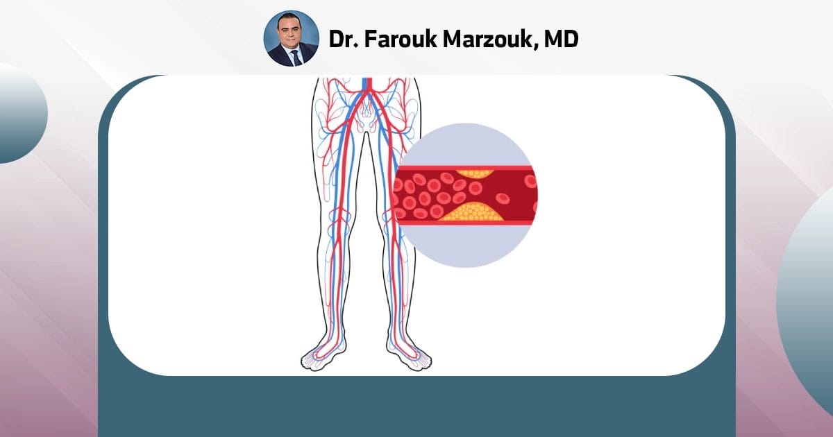 Blockage of arteries in legs | How do you treat clogged arteries in ...