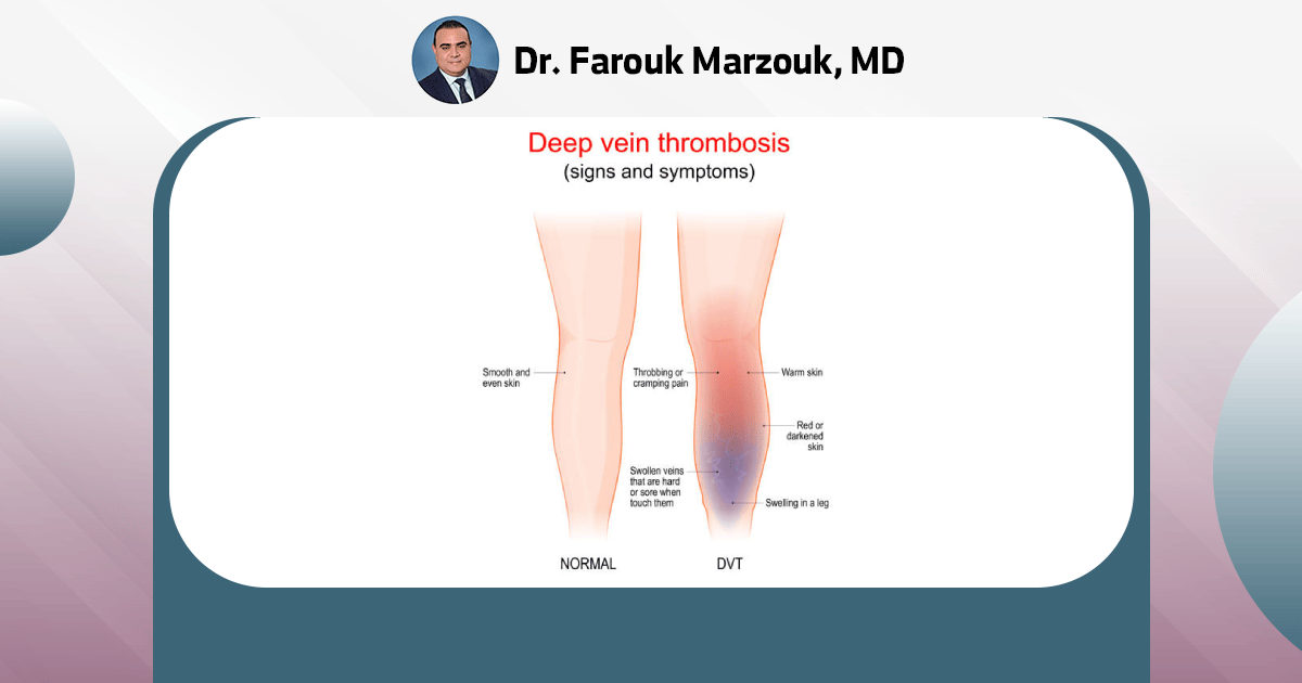 Deep Vein Thrombosis (DVT) | What Causes Deep Vein Thrombosis? - Farouk ...