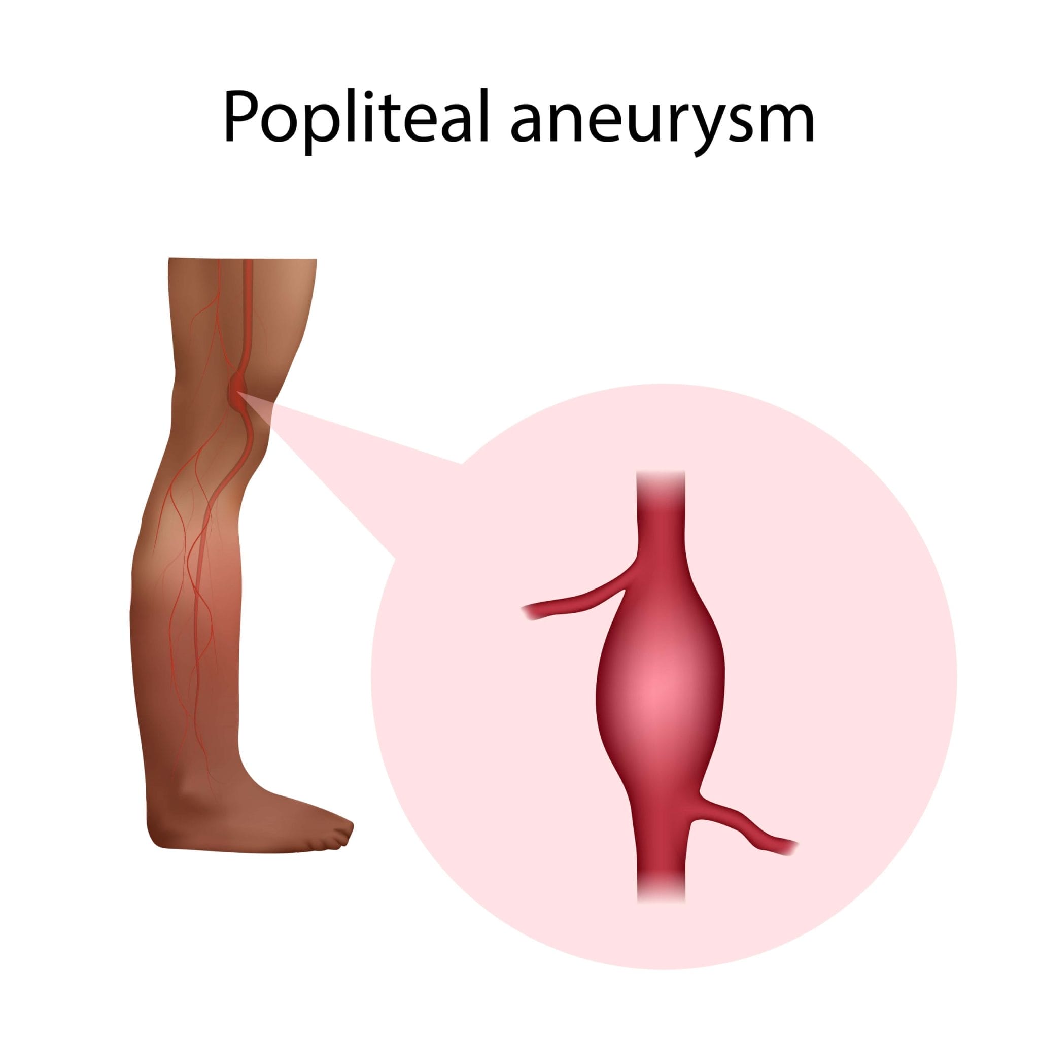 Popliteal Artery Aneurysm | Symptoms And Causes