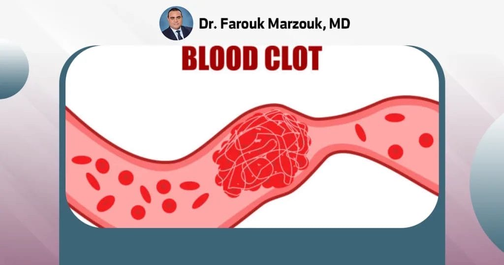 Blood clot - Farouk Marzouk, MD
