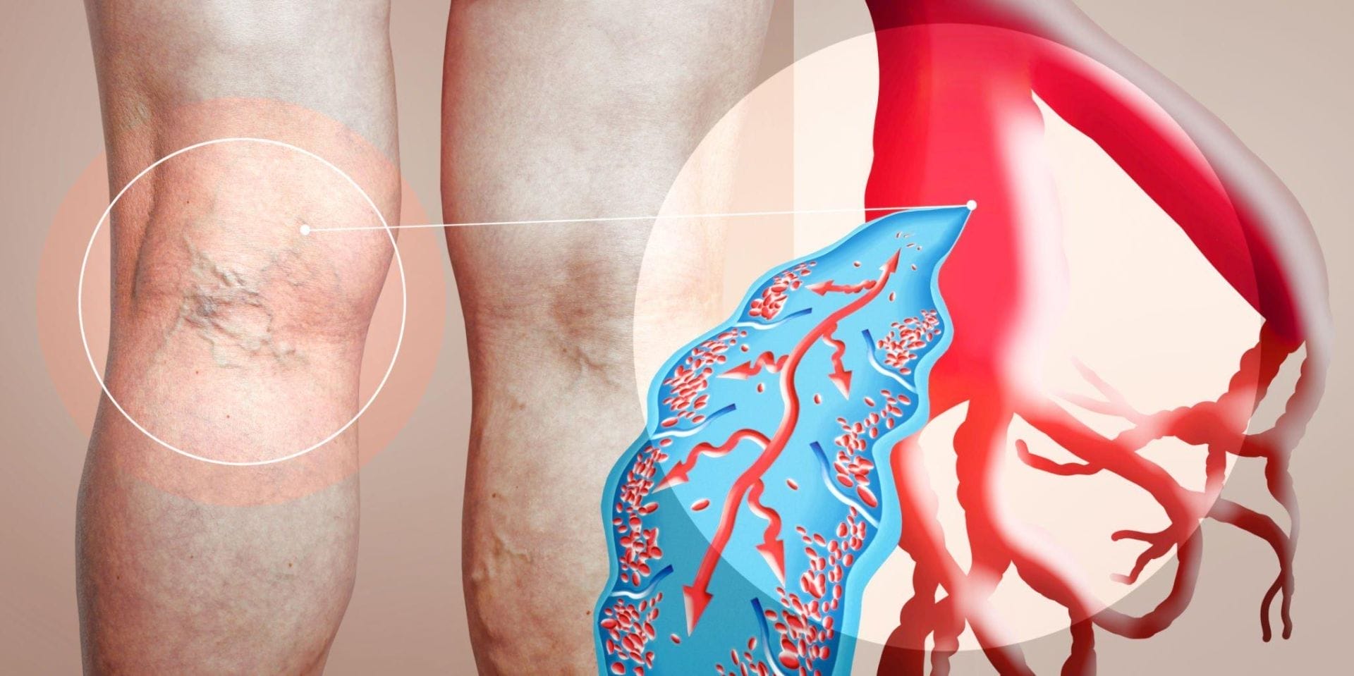 venous stents | How long do venous stents last?