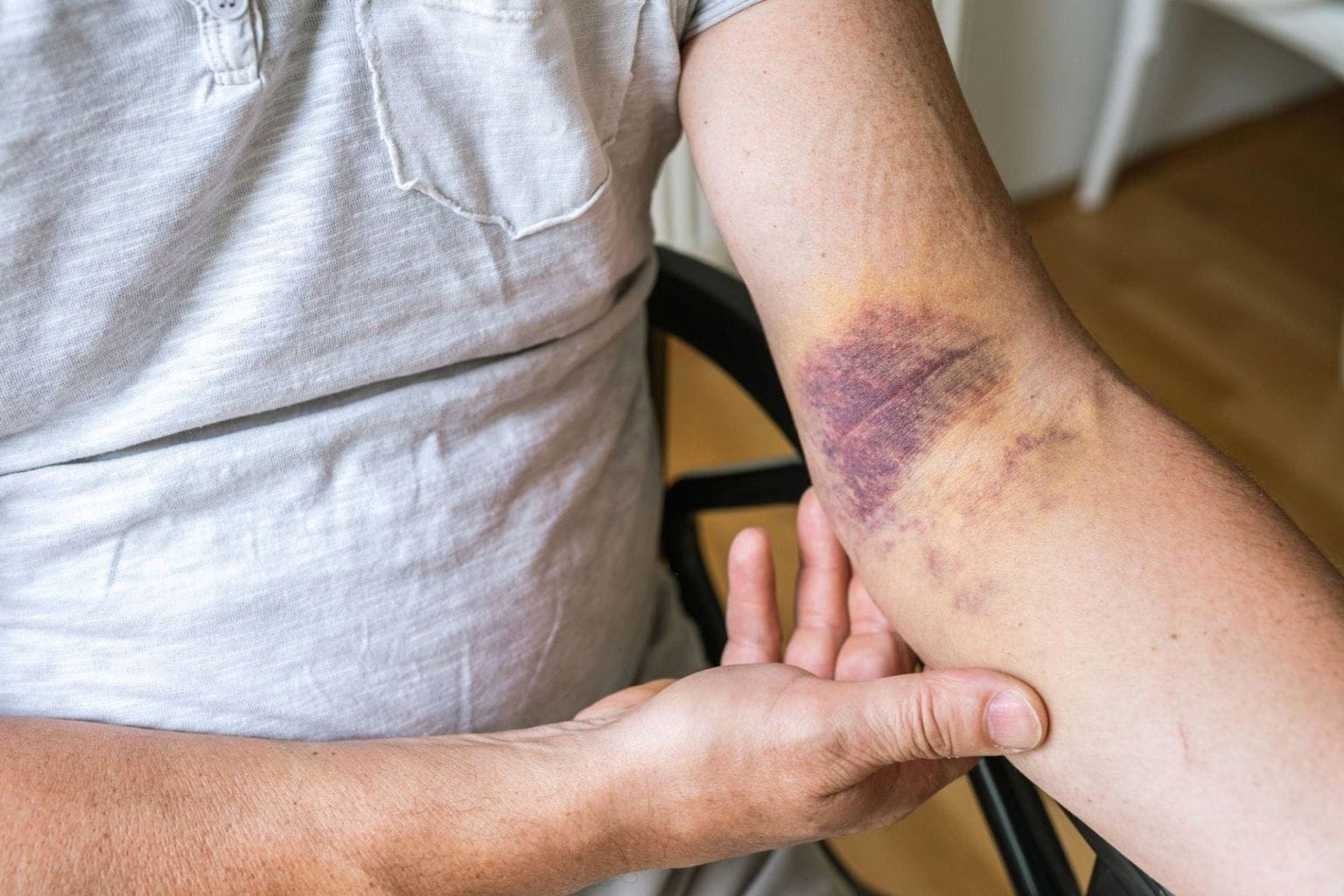 Blood Clot In Arm: Symptoms & Advanced DVT Treatment