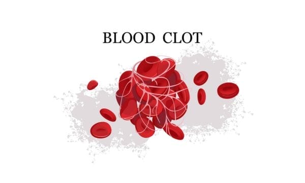 Blood clot | What is the cause of blood clots? - Farouk Marzouk, MD