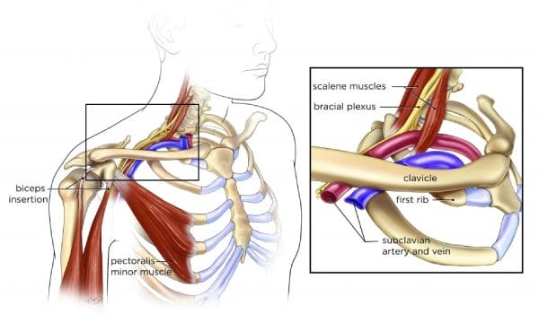 Thoracic Outlet Syndrome | Symptoms And Causes