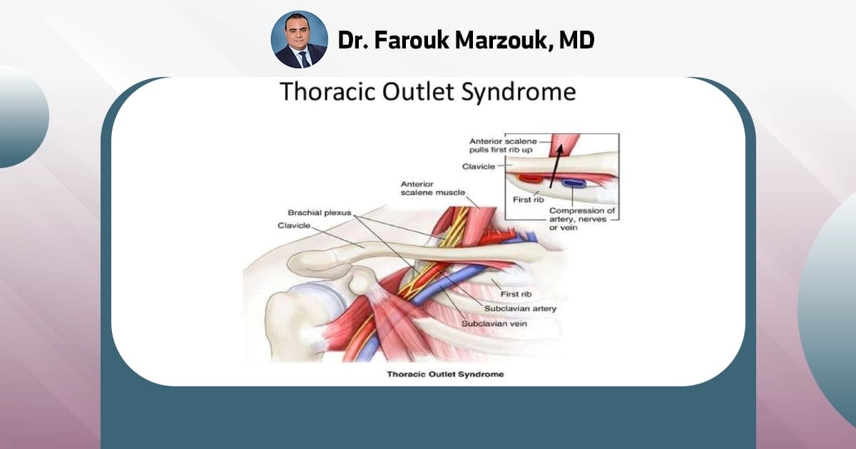 Thoracic Outlet Syndrome | Symptoms And Causes