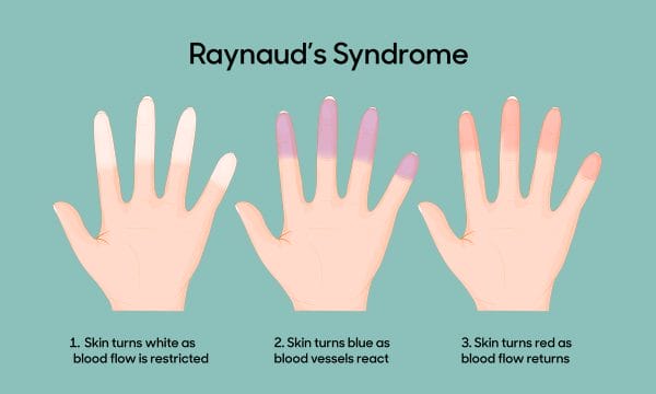 How To Manage Raynaud's Syndrome - Frontier Medical Care