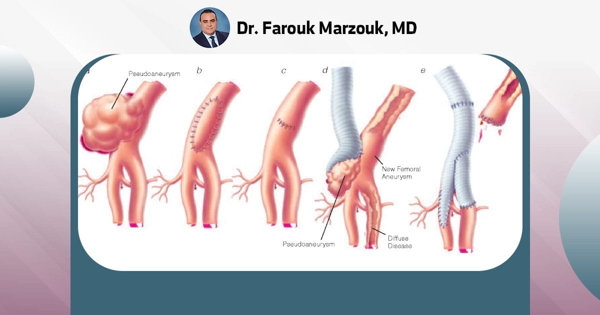 Popliteal Artery Aneurysm | Symptoms And Causes