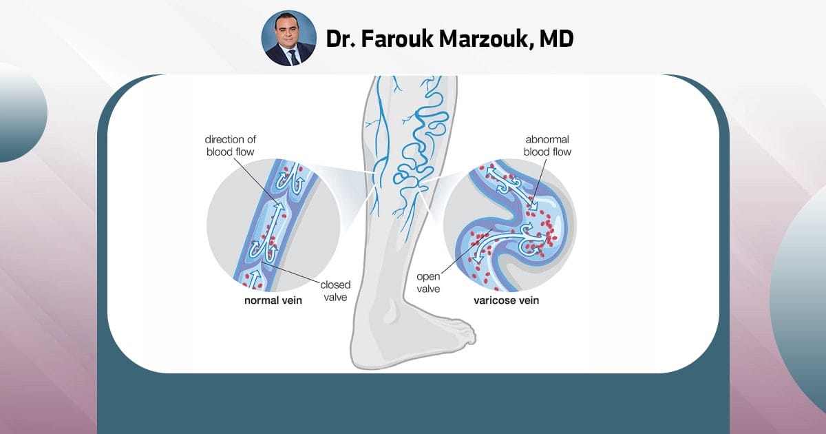 What Is The Best Treatment For Varicose Veins