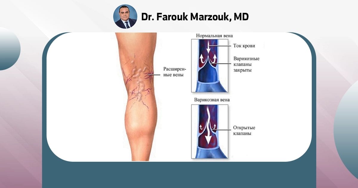Medical Treatment For Varicose Veins - Frontier Medical Care