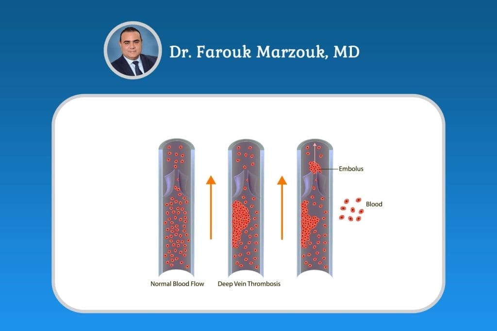 Deep Vein Thrombosis (DVT) Treatment In Brooklyn, NY