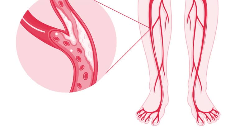 Life Expectancy Of Person With PAD: What Doctors Says