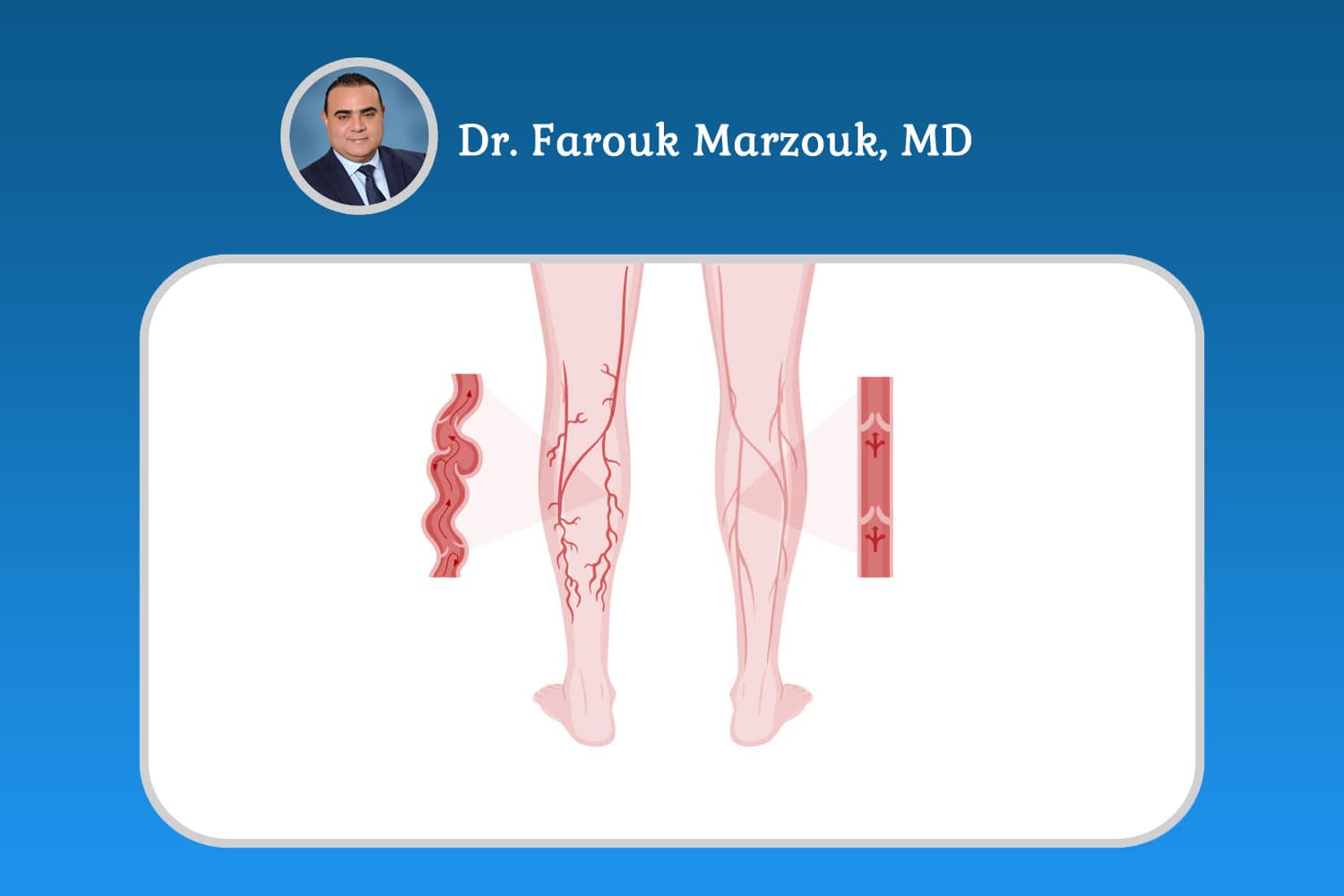 Varicose Veins In One Leg Only - Causes And Treatments