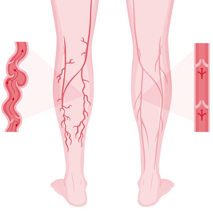 What Is The Best Treatment For Venous Insufficiency