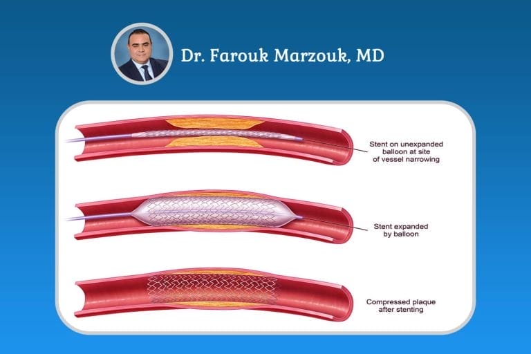 Balloon Angioplasty Vs Stent: Key Differences And Benefits