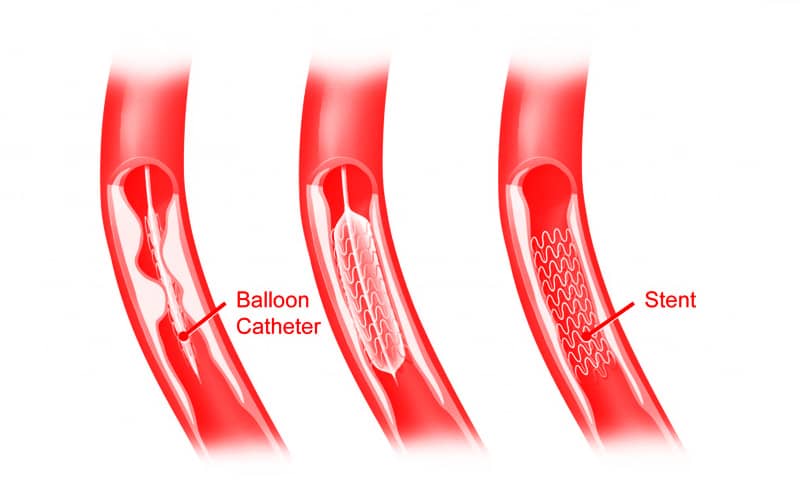 Balloon Angioplasty Vs Stent: Key Differences And Benefits