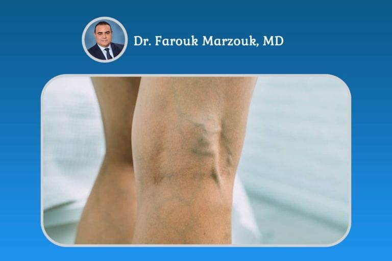 Blood Clot Behind Knee | Causes, Symptoms & Safe Treatment