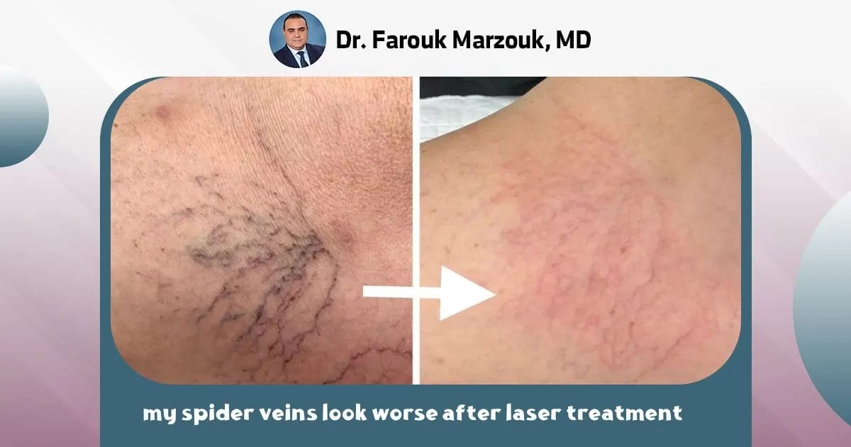 Why Do My Spider Veins Look Worse After Laser Treatment