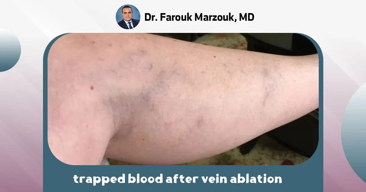 What Is A Vascular Grafting ? | Farouk Marzouk, MD