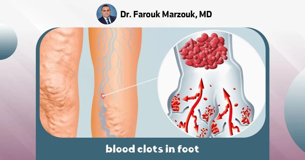 Blood Clots In Foot: Symptoms, Risks And When To Seek Help