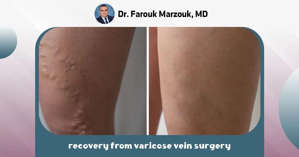 Spider Veins Vs Varicose Veins: Differences, And Treatment