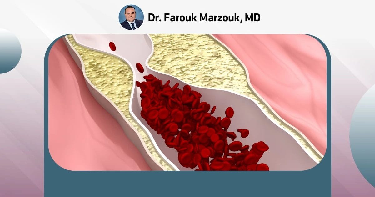 What Is The Treatment For Blockage Of Arteries In Legs