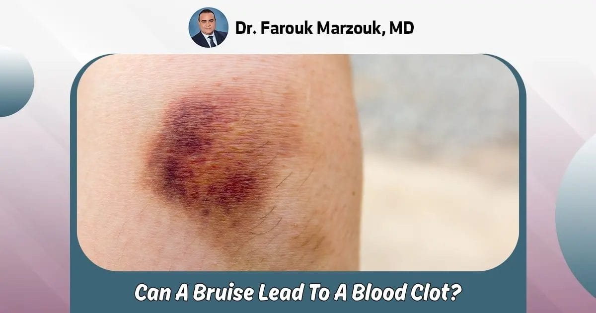 DVT Test Squeeze Calf | How To Know If Calf Pain Is DVT?