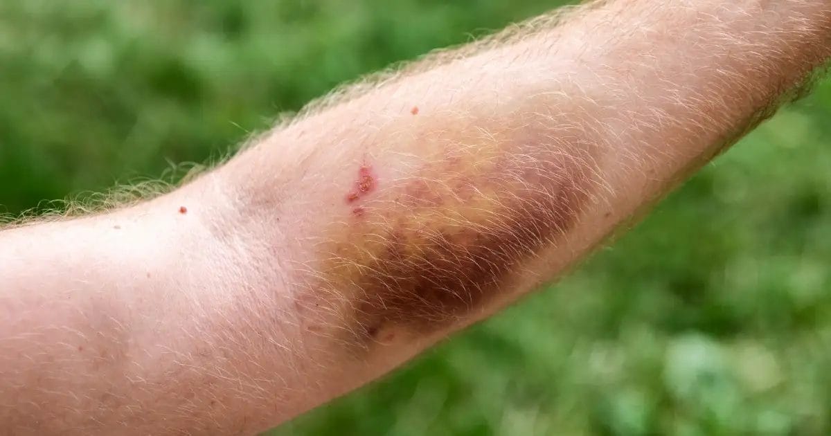 Can A Bruise Lead To A Blood Clot? When To See Doctor