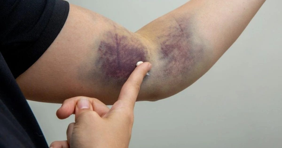 Can A Bruise Lead To A Blood Clot? When To See Doctor