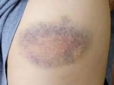 Can A Bruise Lead To A Blood Clot? When To See Doctor