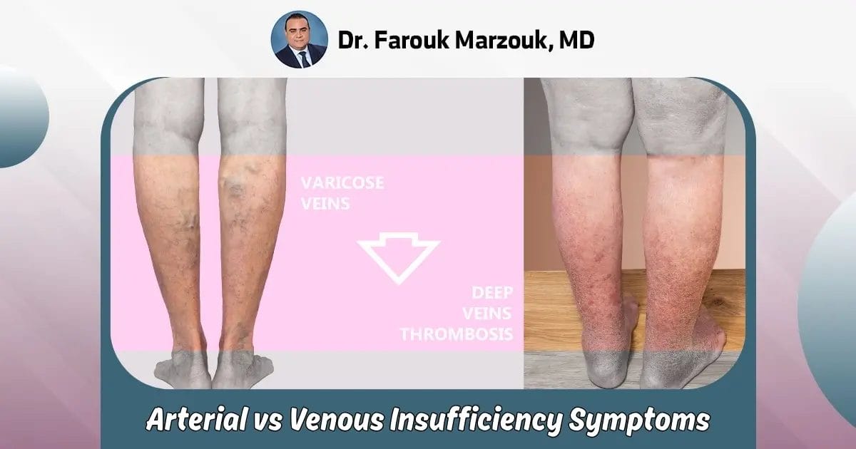 What Is The Best Treatment For Venous Insufficiency